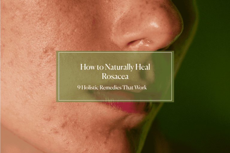 How to Naturally Heal Rosacea: 9 Holistic Remedies That Work